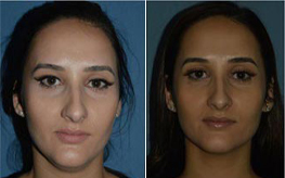 Top Plastic Surgeon San Diego | Alexander Plastic Surgery