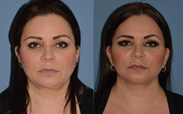Reviews San Diego | Alexander Cosmetic Surgery
