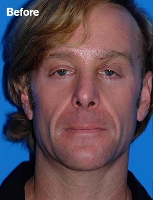 Best Cheek Enhancements San Diego | Alexander Cosmetic Surgery