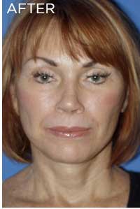 Best QuickLift San Diego | Alexander Cosmetic Surgery