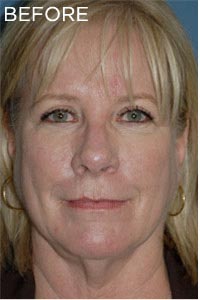 Best QuickLift San Diego | Alexander Cosmetic Surgery