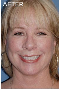 Best QuickLift San Diego | Alexander Cosmetic Surgery