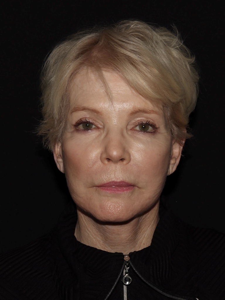 Before and After Photos San Diego, CA - Plastic Surgery Gallery Dr ...